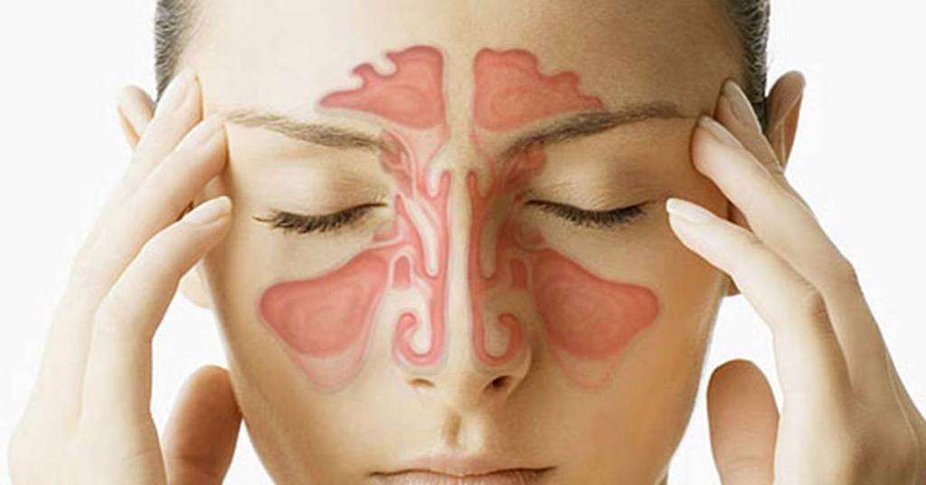 Sinusectomia: Benefícios para Quem Tem Sinusite Crônica