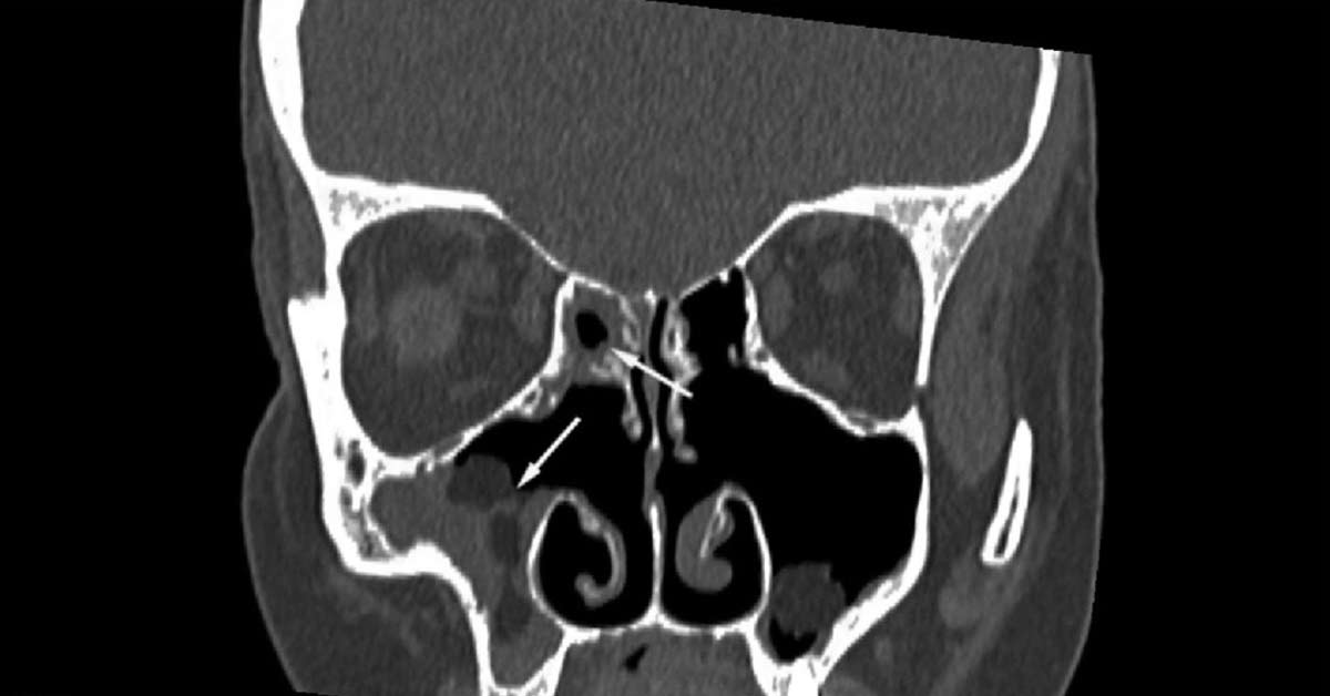 Os Benefícios da Sinusotomia Esfenoidal
